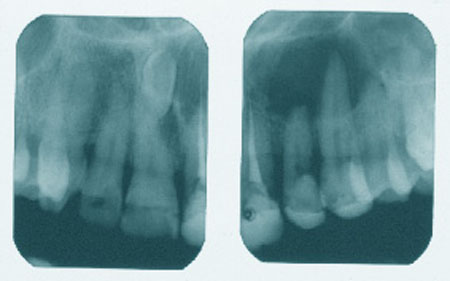 Dentigerous Cyst – Dr. Galil Clinical Cases