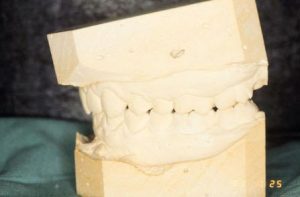 Michigan Bite Splint – Dr. Galil Clinical Cases